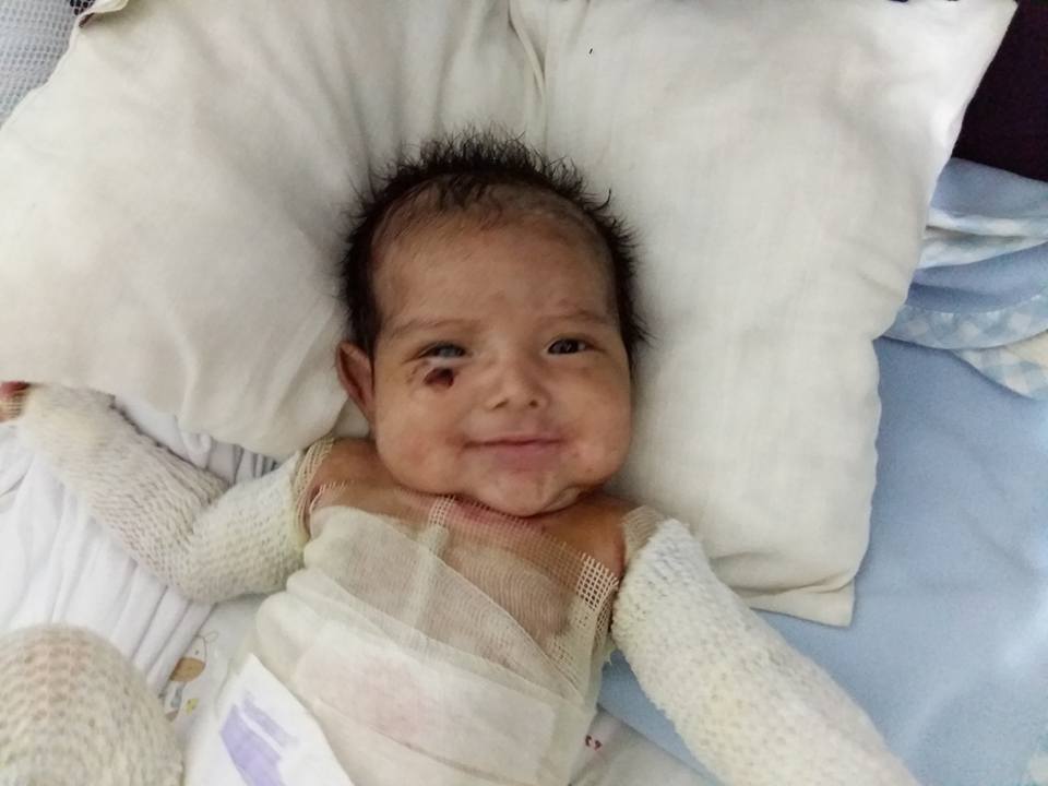 Chimbote: Este lunes inician campaña a favor de Samuelito, bebe piel de ...